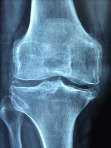 The Complete Guide to Knee Osteonecrosis: Causes, Risk Factors ...