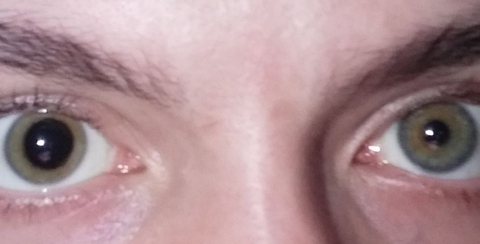 Anisocoria Latest Facts: Causes, Risk Factors, Diagnosis and Treatments ...