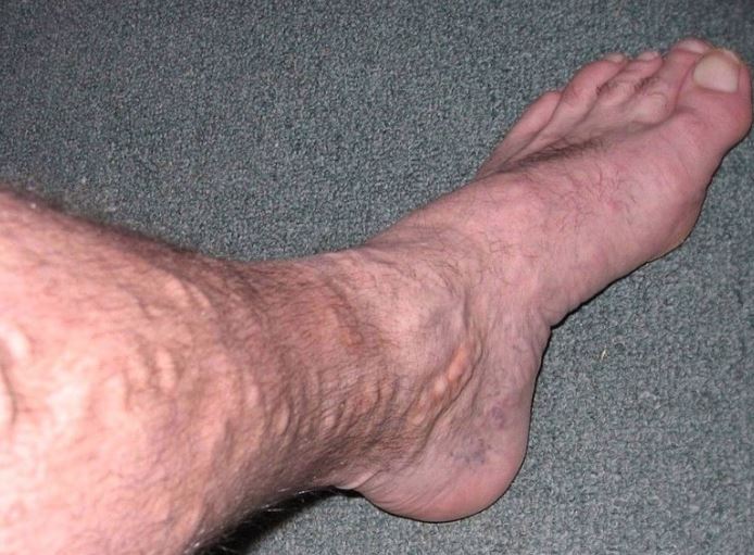 The Causes, Symptoms, and Treatment Options for Varicose Veins: A ...