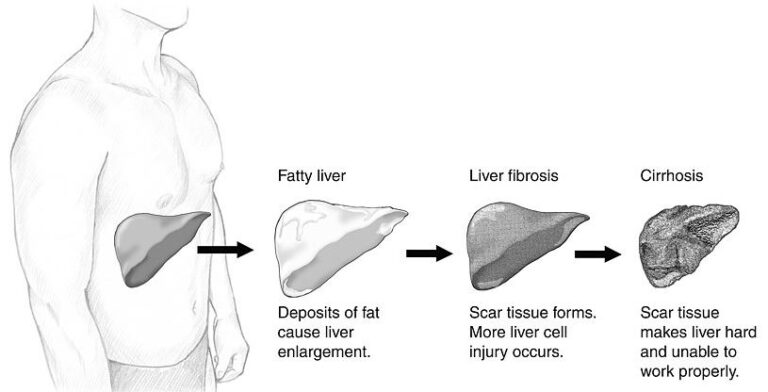 Non-alcoholic Fatty Liver Disease (NAFLD) Can Cause Anxiety and ...
