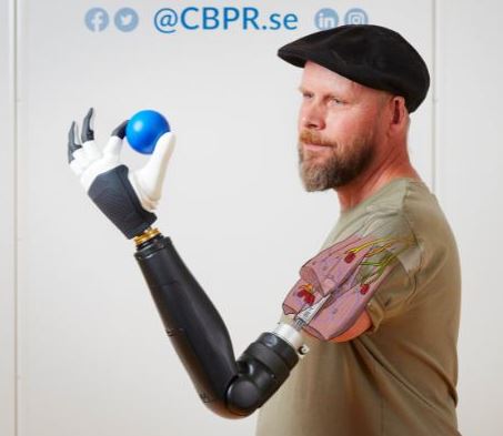 Bionics Breakthrough: How Rewired Nerves and AI Are Giving Amputees a ...
